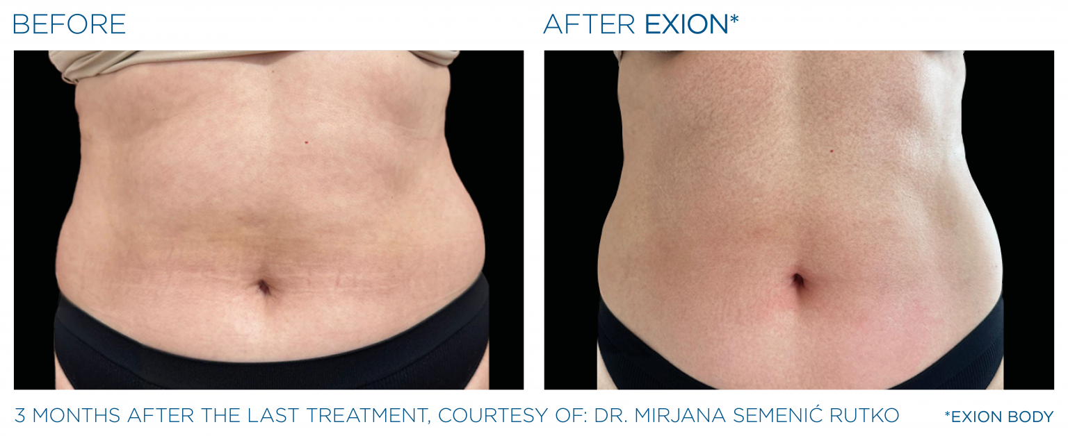 Exion Radiofrequency Treatment: Skin Tightening Benefits - ERA Skin ...